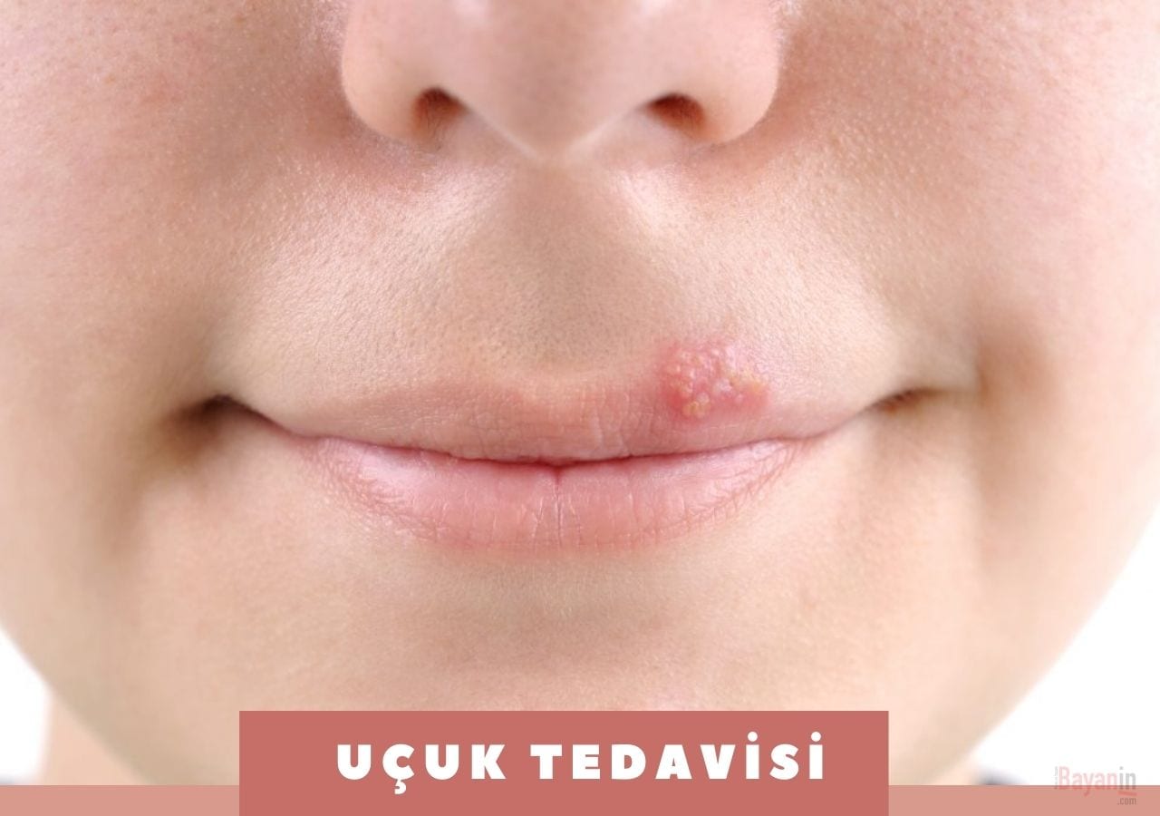 Aklovir Krem Nedir? Ne İşe Yarar? Sivilceye İyi Gelir mi?