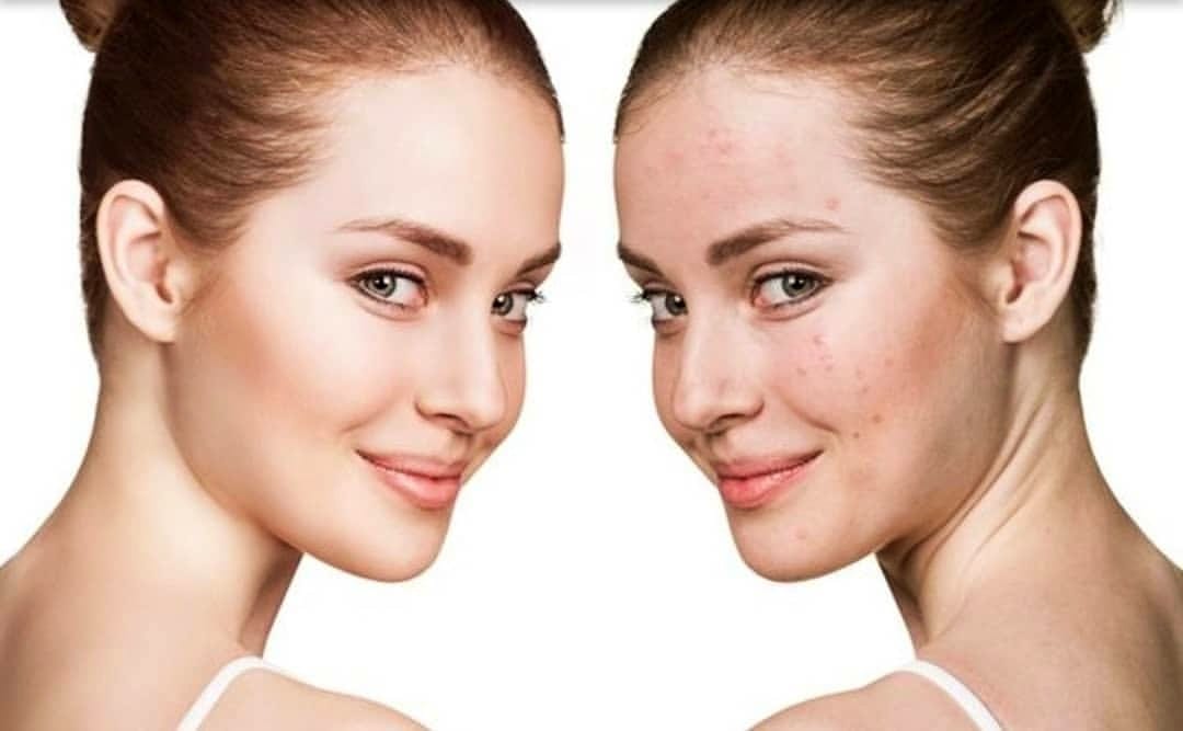 Maya Maskesi Tarifi : Nasıl Yapılır? Faydaları | Gençleştiren Maske